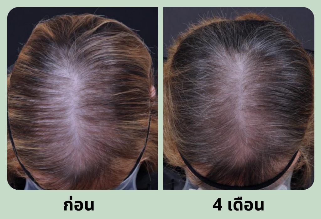 Procapil™ สารออกฤทธิ์ตัวตึง ช่วยลดผมร่วงจากฮอร์โมน DHT - AloEx หยุดผม ...